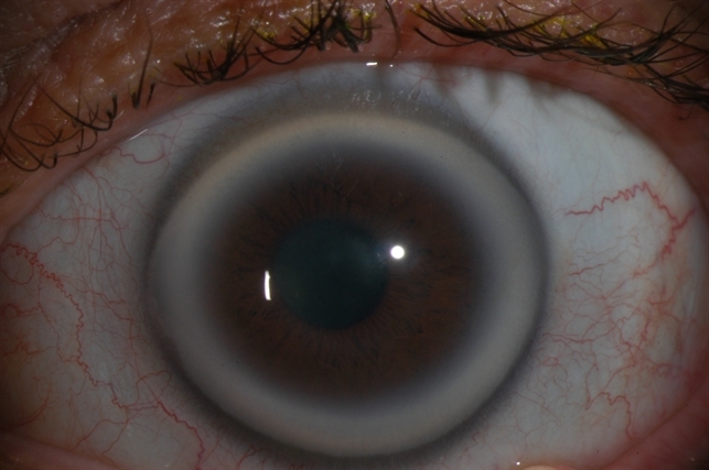 Šta je Arcus senilis? - PORTAL ZA ZDRAV POGLED